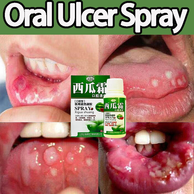 Mouth ulcer spray Oral Ulcer Spray watermelon frost Spray Canker Sores ...