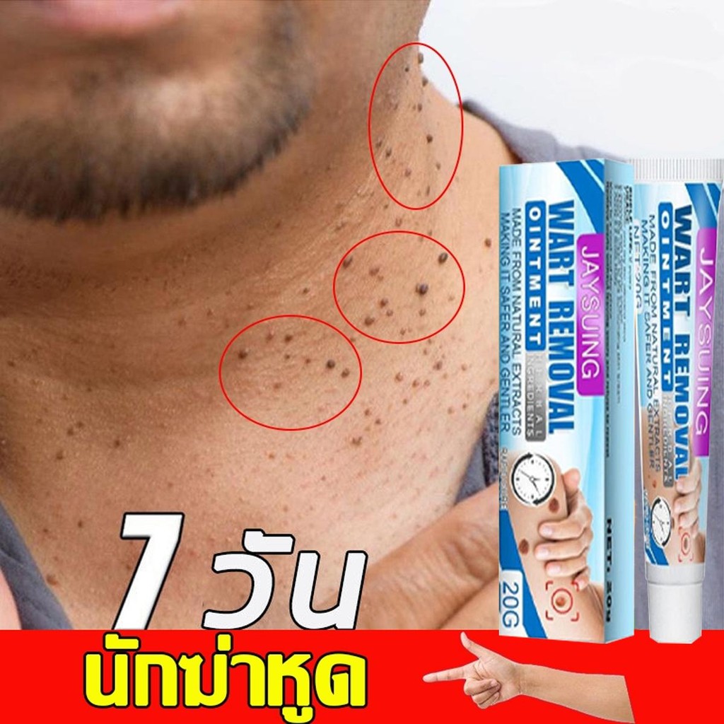 Mole cream, pendant, mole, wart, wart, fish eyes, freckles, acne, stone ...