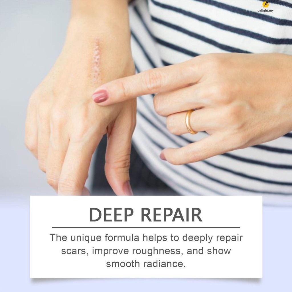 Skin Scar Removal Repair Cream Practical Scar Relief Cream Smooth Cream ...