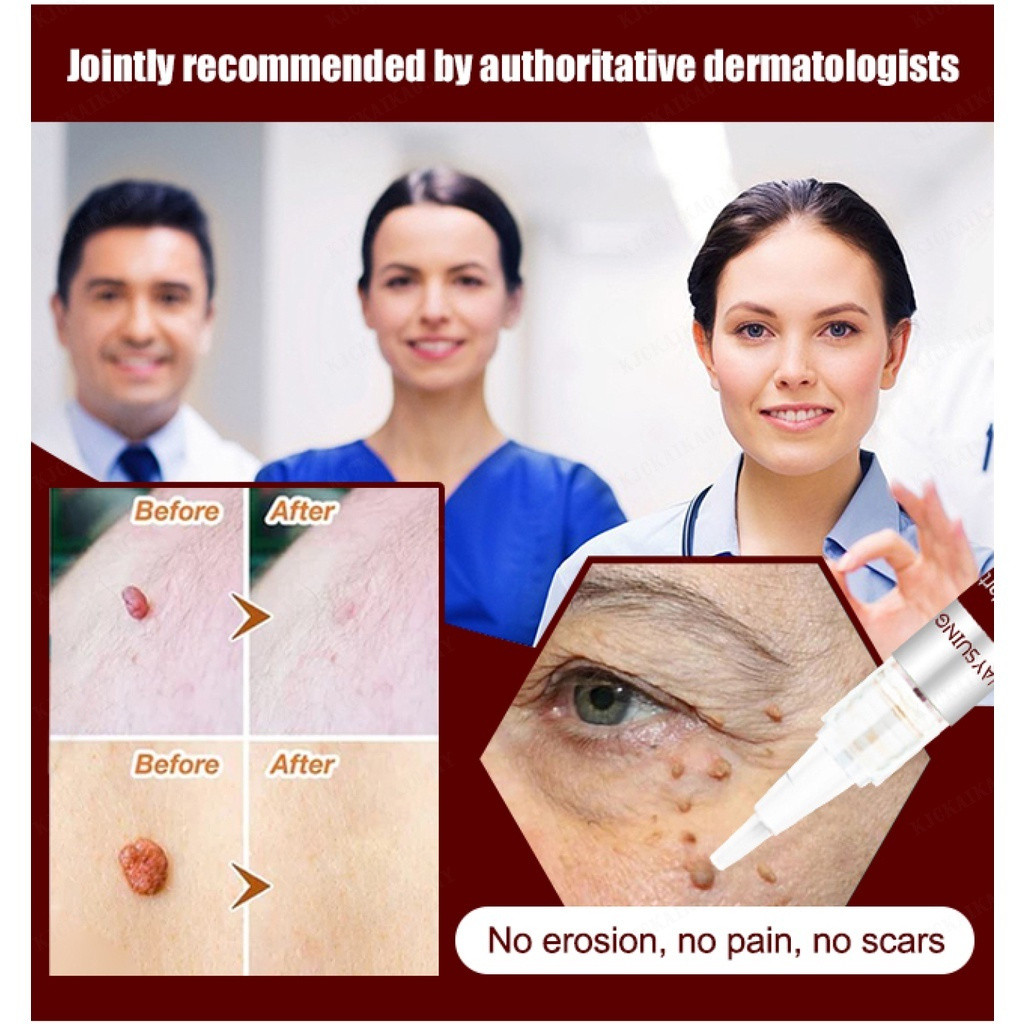 Wart Remover Skin Tag Mole Remover wart removal liquid pen medicine ...