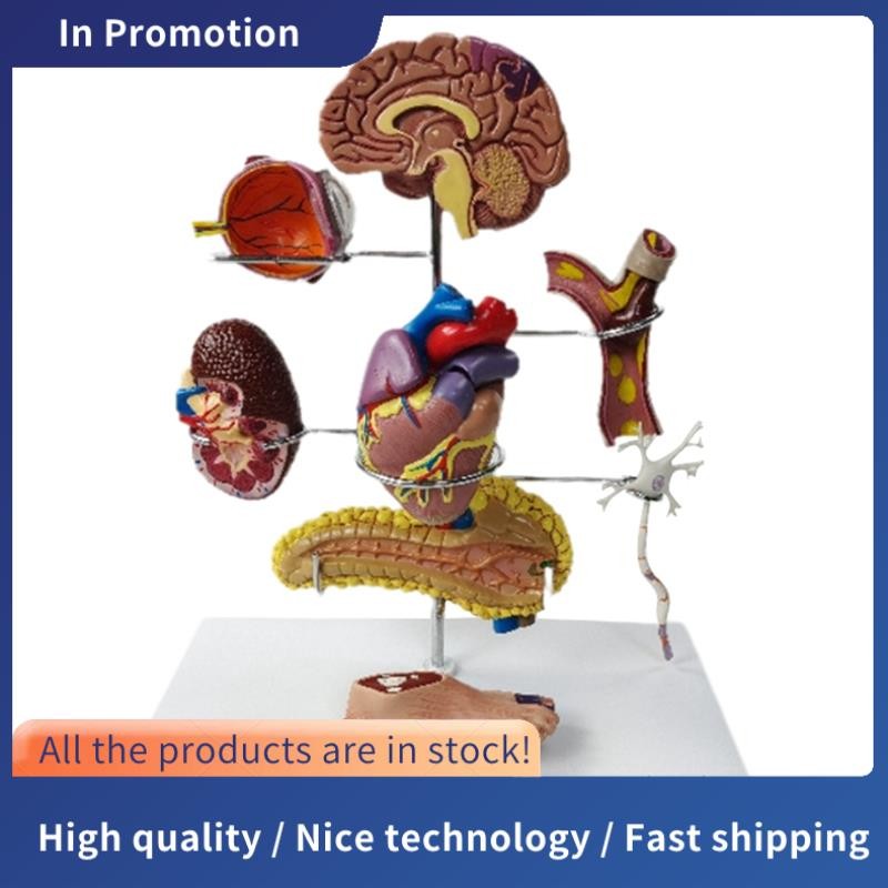 Type Ii Diabetes Model Set, for Human Anatomy and Physiology Education ...