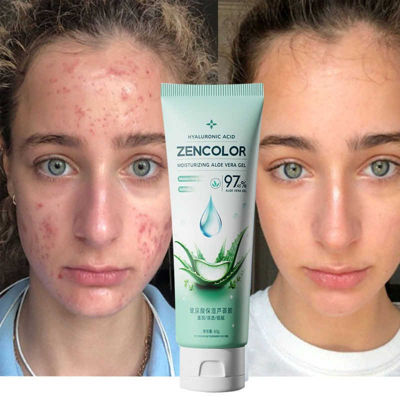 Aloe Vera Gel Face Cream Acne scar Treatment for facial acne Soothing ...