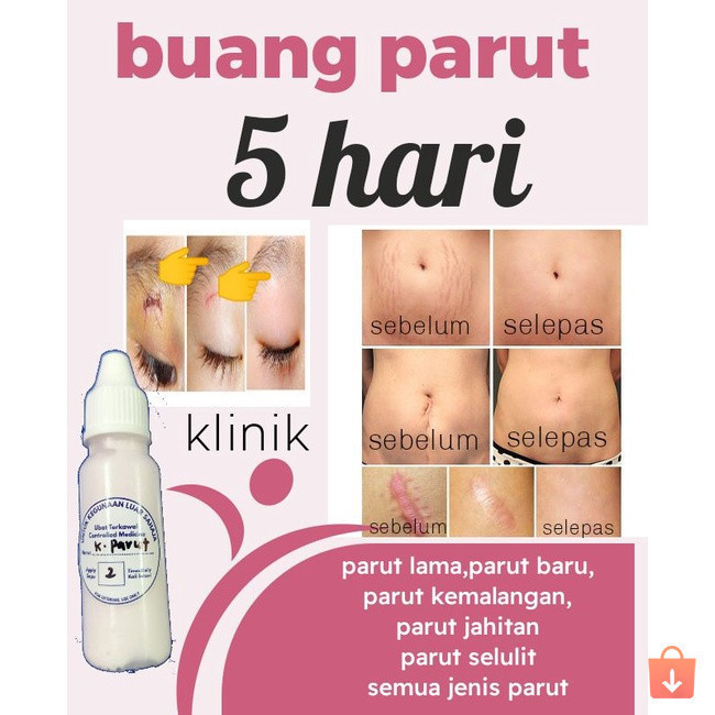 ready stok,krim parut /hilang parut/pudar parut/parut lama/parut baru ...