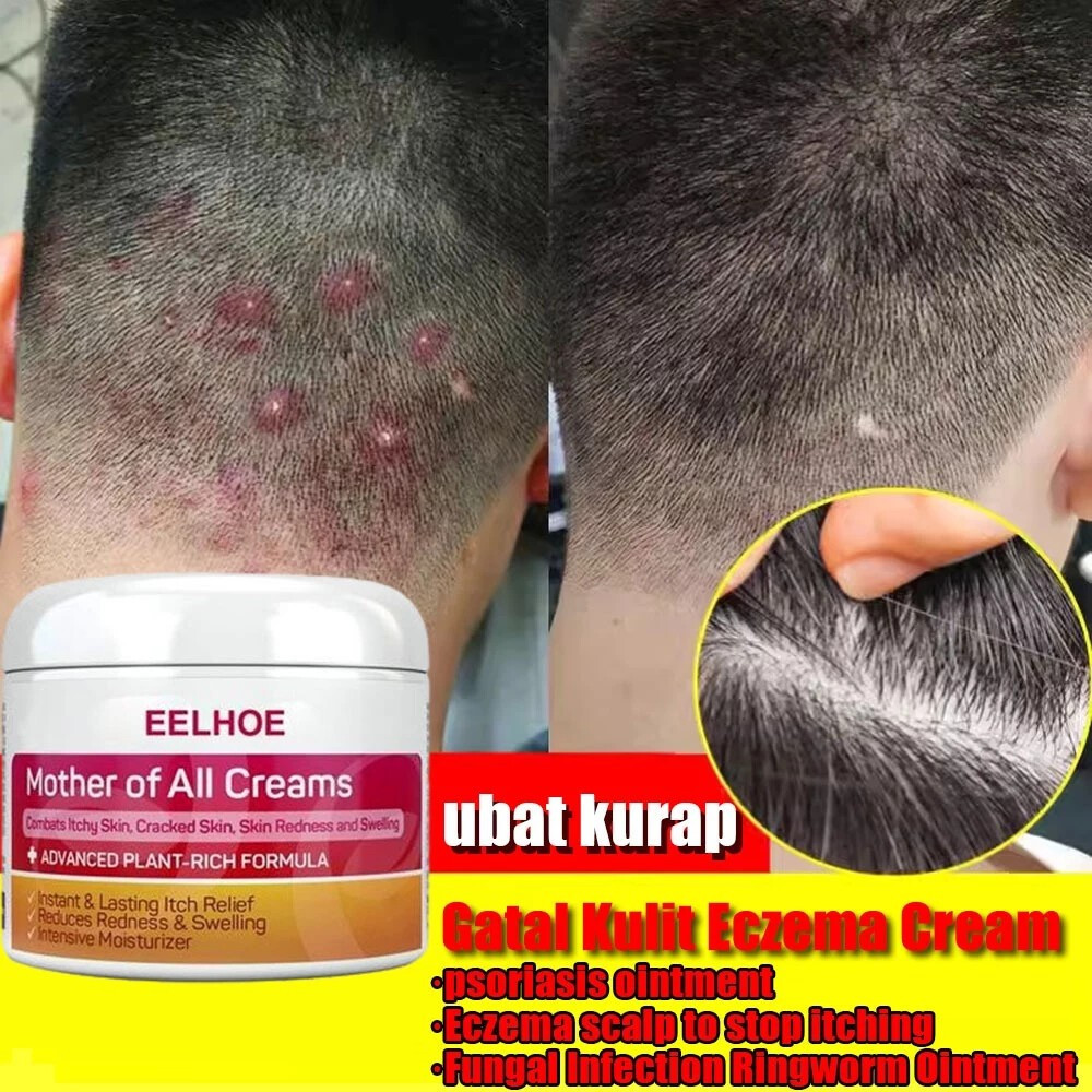Special Ointment for Headscalp Hair Follicles Yan Scalp Pimples Acne ...