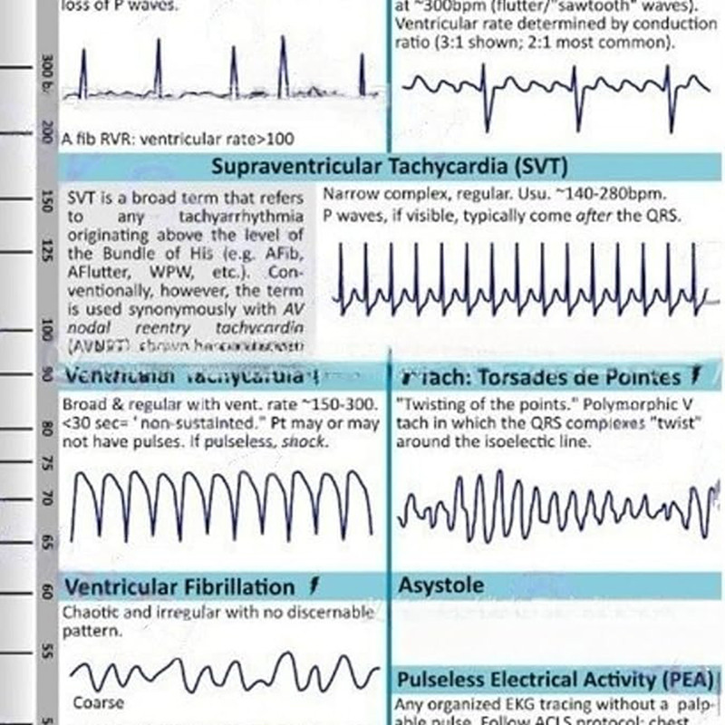 [ndr] EKG Pocket Guide, EKG Rhythm Interpretation, Double Sided Compact ...