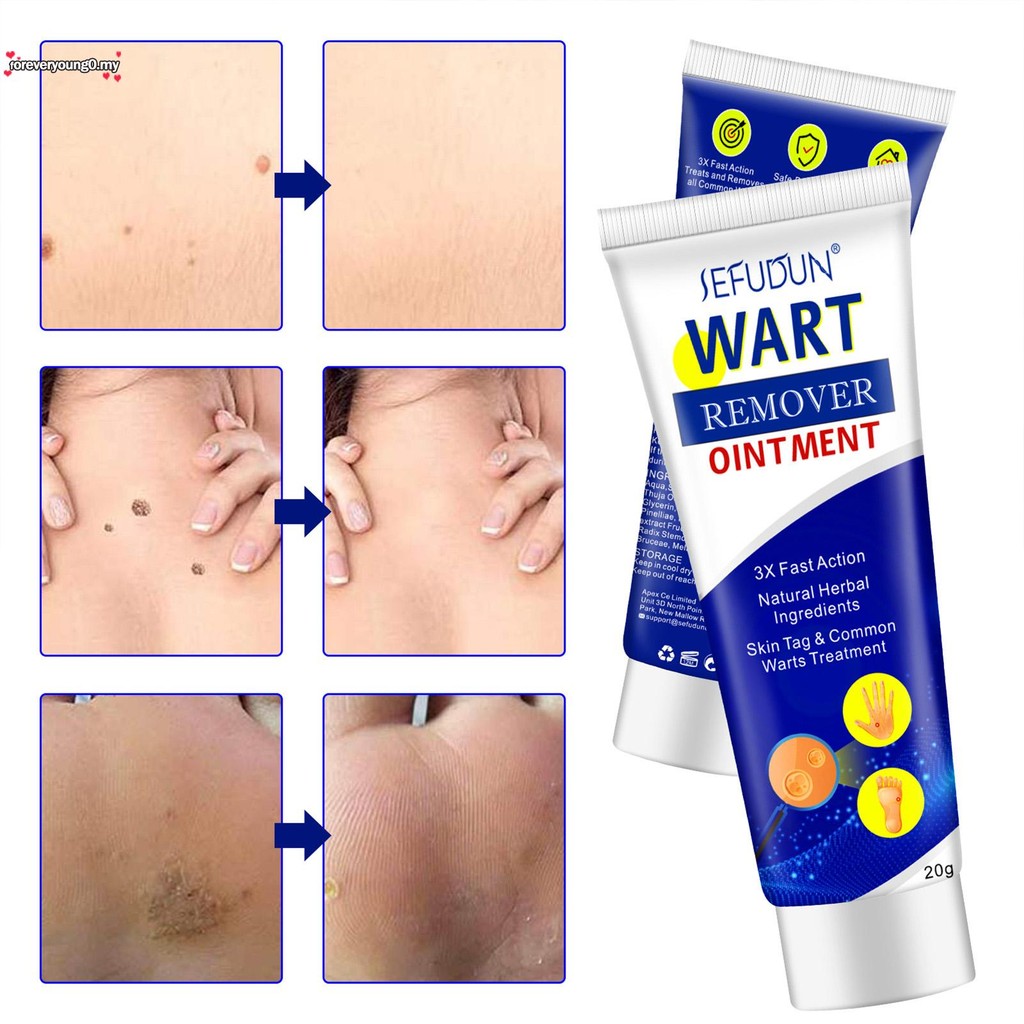 Skin Wart Remover Cream Repairing Fast Acting Cleaning Wart Remover for ...