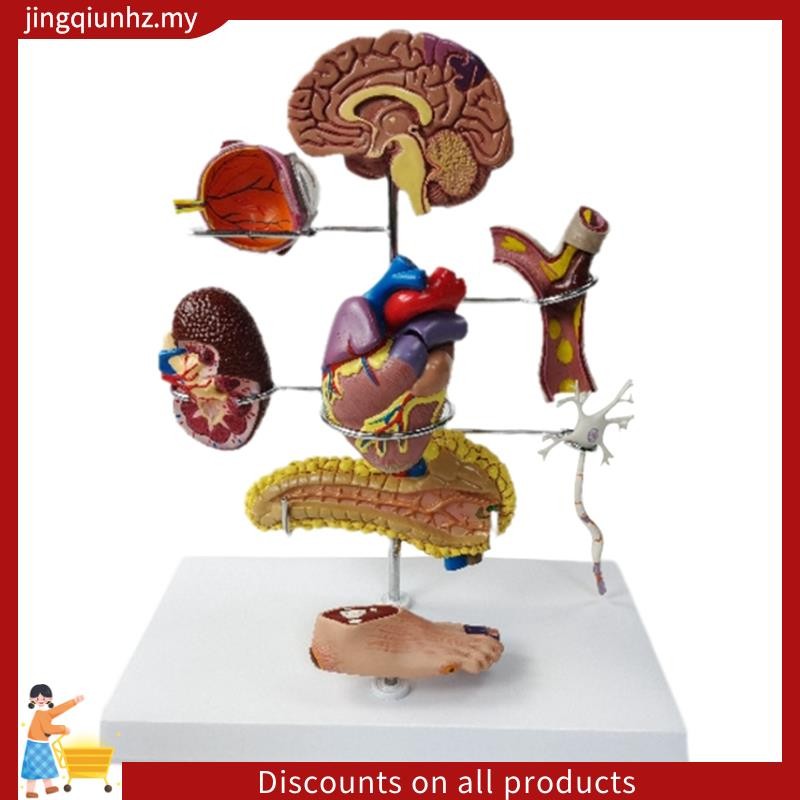 [in stock]Type Ii Diabetes Model Set, for Human Anatomy and Physiology ...