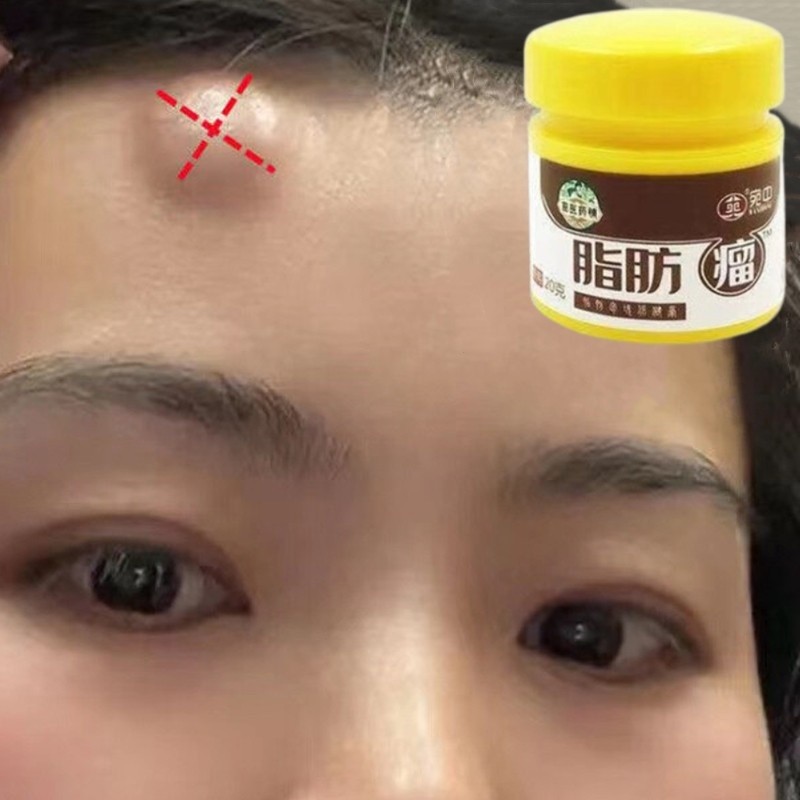 subcutaneous lipoma lump swelling ointment cream bump removing Lioma ...