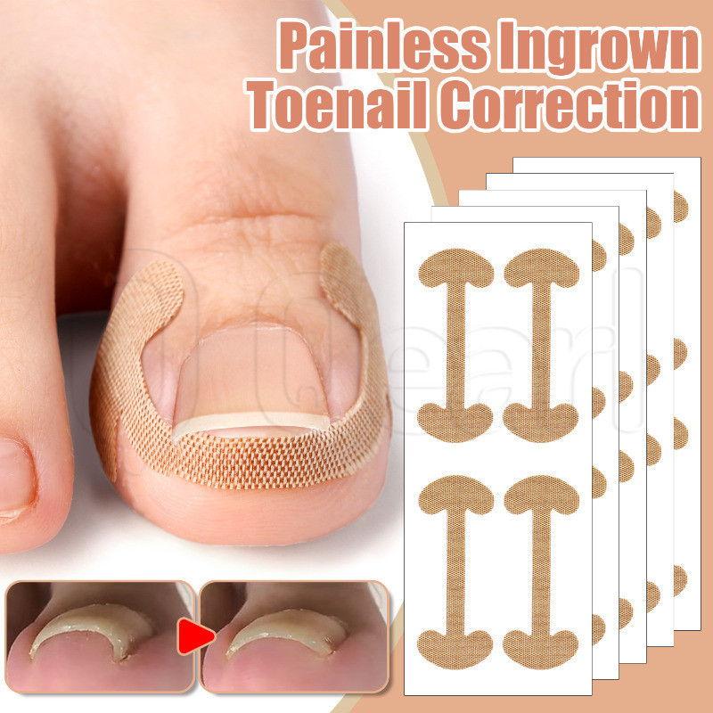 Ingrown Toenail Correction Sticker - Nail Treatment Corrector - Nail ...