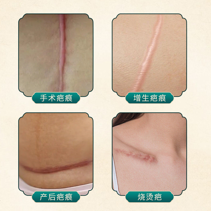 Thai Scar Cream Skin Scar Repair Cream Postpartum Scar Growth Scar ...