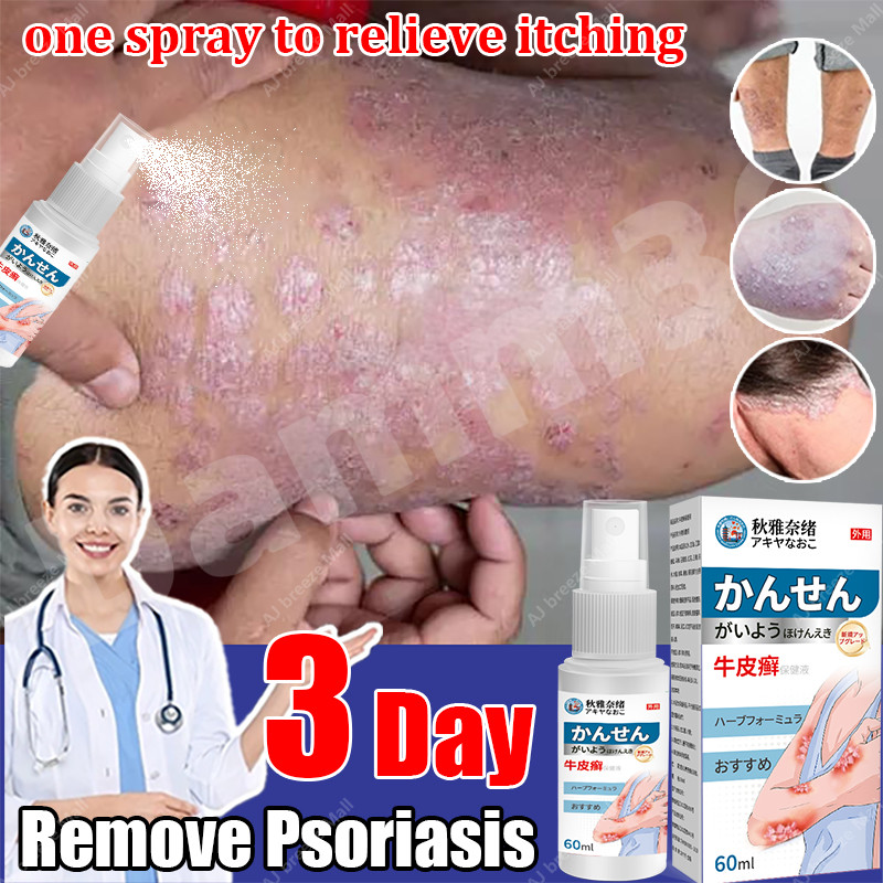 Hot Psoriasis Spray 60ml Eczema Relief Ubat Gatal Kulit Ubat Kurap Anti ...