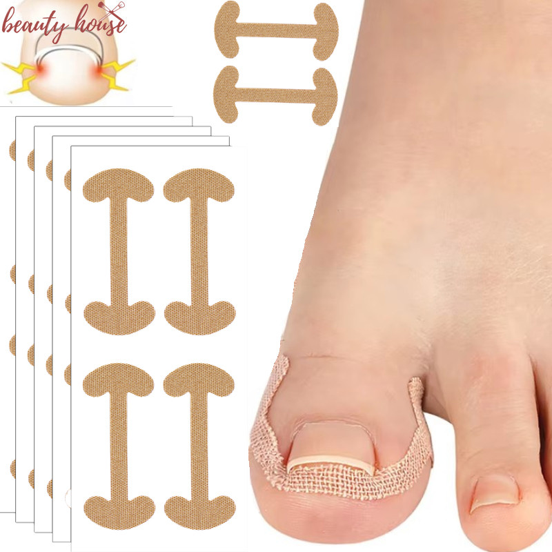 Ingrown Toenail Correction Sticker - Nail Treatment Corrector - Nail ...