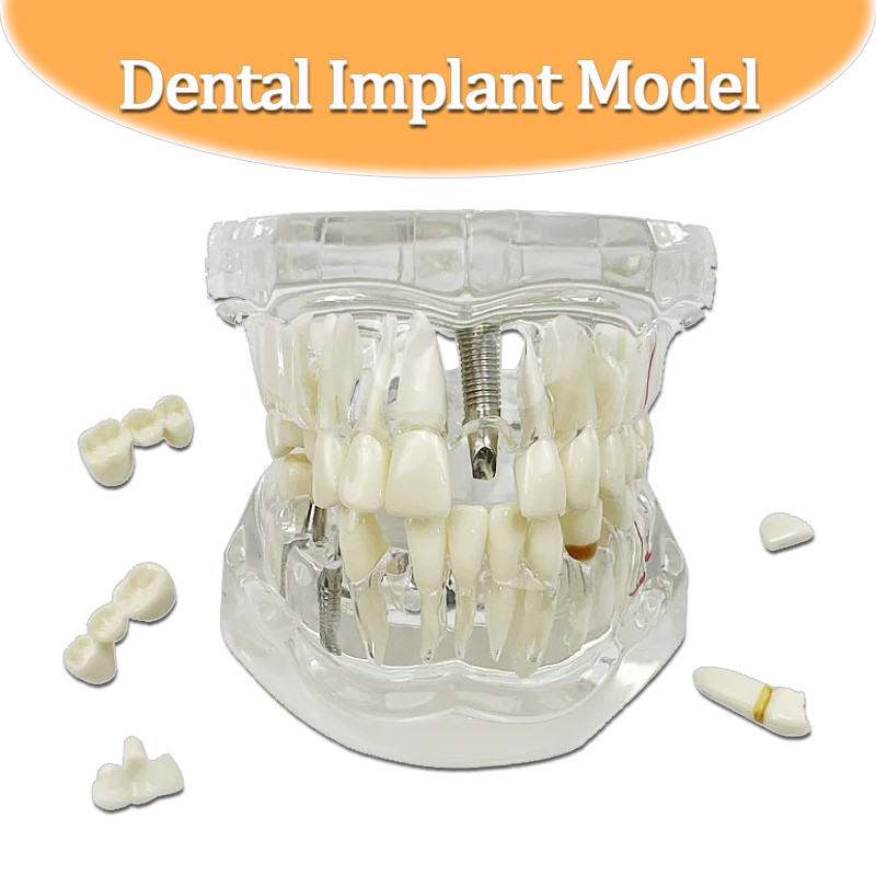 Dental Teeth Model Implant with Removable Dental Education Model for ...