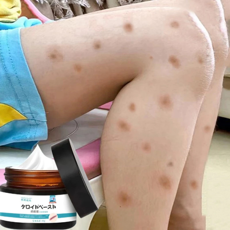 Krim Hilangkan Parut Hitam Scar Removal Cream Ubat Parut Hitam Ubat ...
