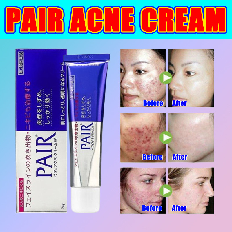 JAPAN Acne Cream Antibacterial Acne Face Cream Fix Your Acne | Shopee ...