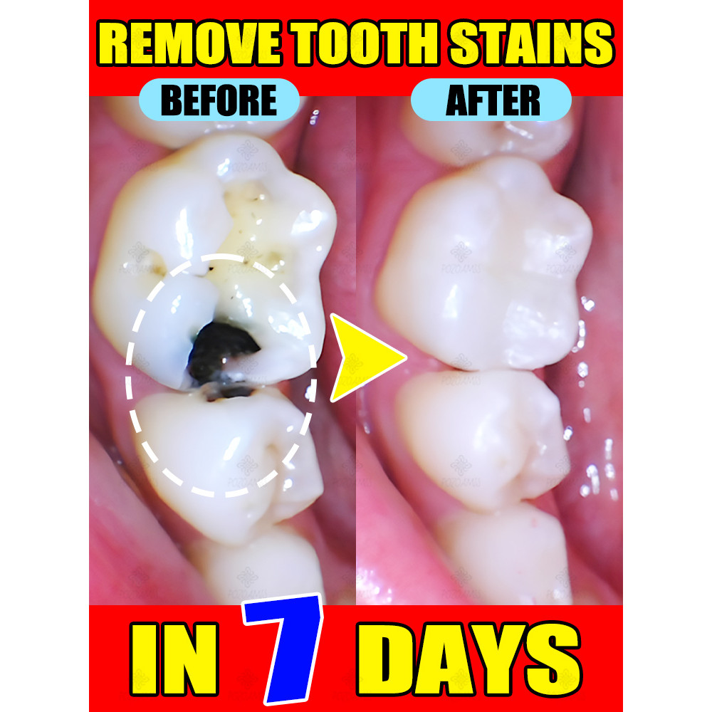 Anti-caries toothpaste, teeth repair toothpaste Tooth Decay Repair deep ...