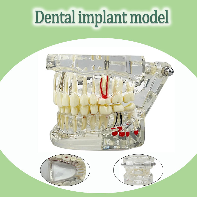 Removable Dental Typodonts Implant Model for Studying Oral Disease ...