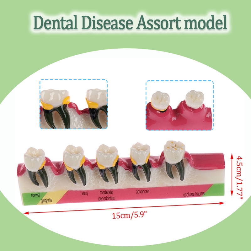 Periodontal Disease Model 5-Stage Disease Assort Demo Caries ...