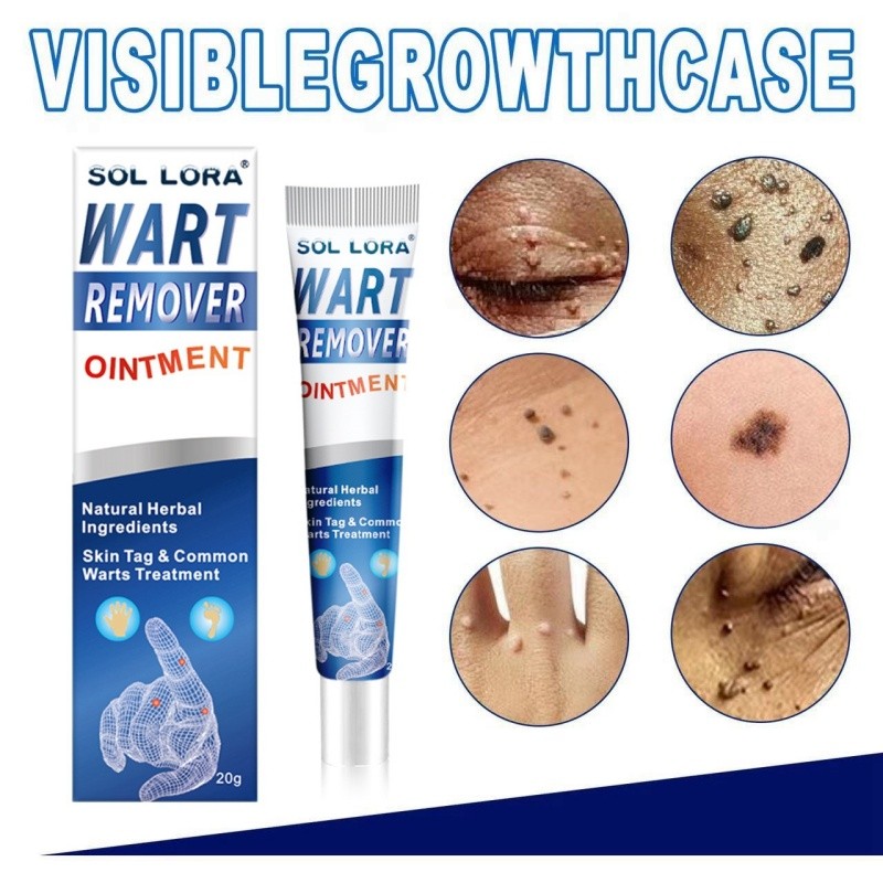 Warts Remover Original Cream Wart Removal Wart Treatment Skin Tags Mole ...