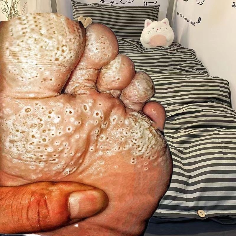 Skintific nested keratolytic disease honeycombed sandworms on the sole ...