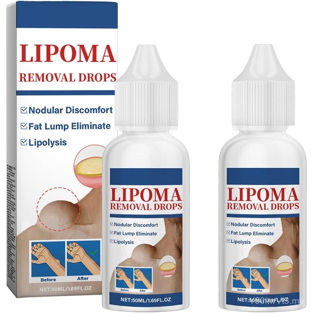 Herbal Lipoma Removal Drops,Lipoma Removal,Lipoma Removal Cream ...