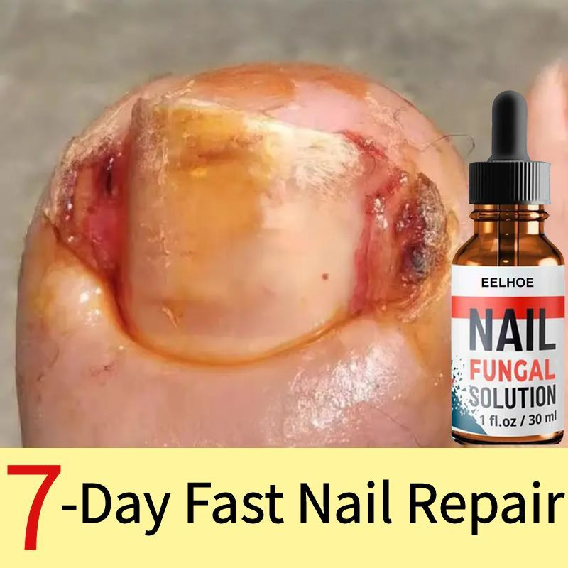 Jiagou Kang Paronychia Ingrown Nails Relieve Pain Redness Swelling Pain ...