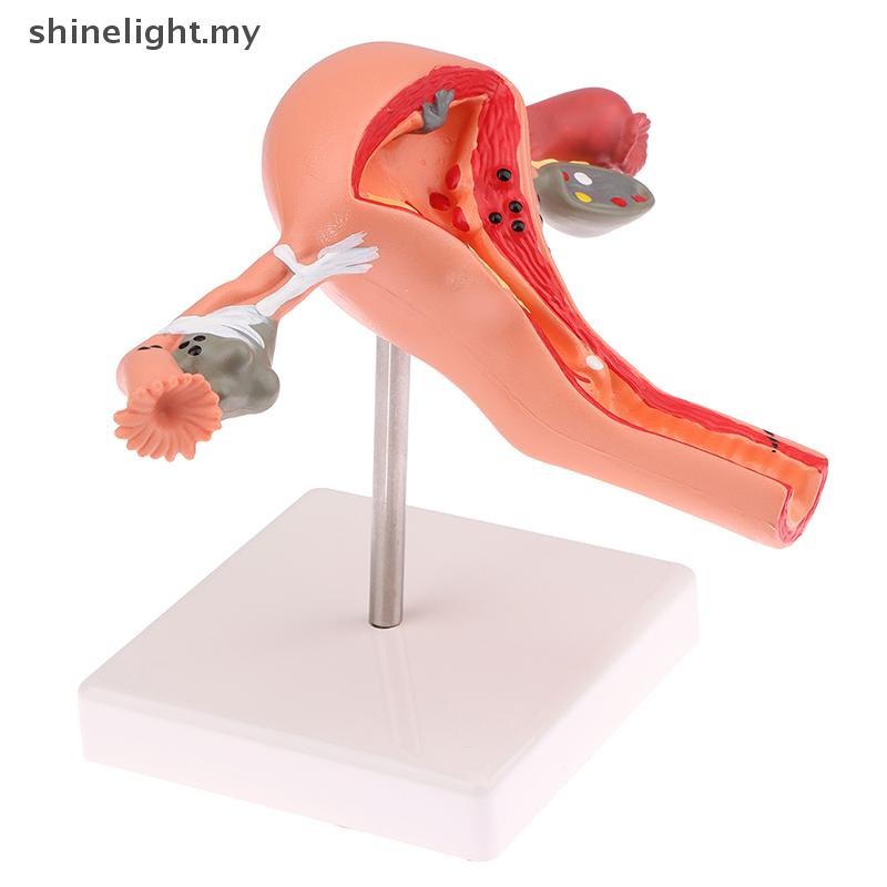 [Shinelight] 1Pcs Props Model Pathoical Uterus Ovary Anatomical Model ...