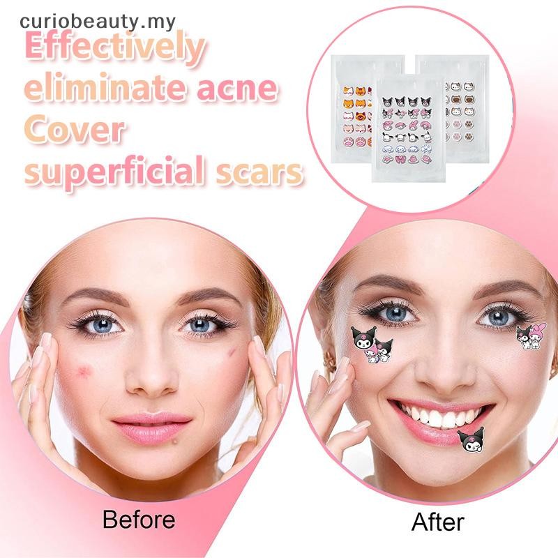 【CBMY】 20/24Pcs Acne Pimple Patch Sticker Acne Pimple Remover Tool ...