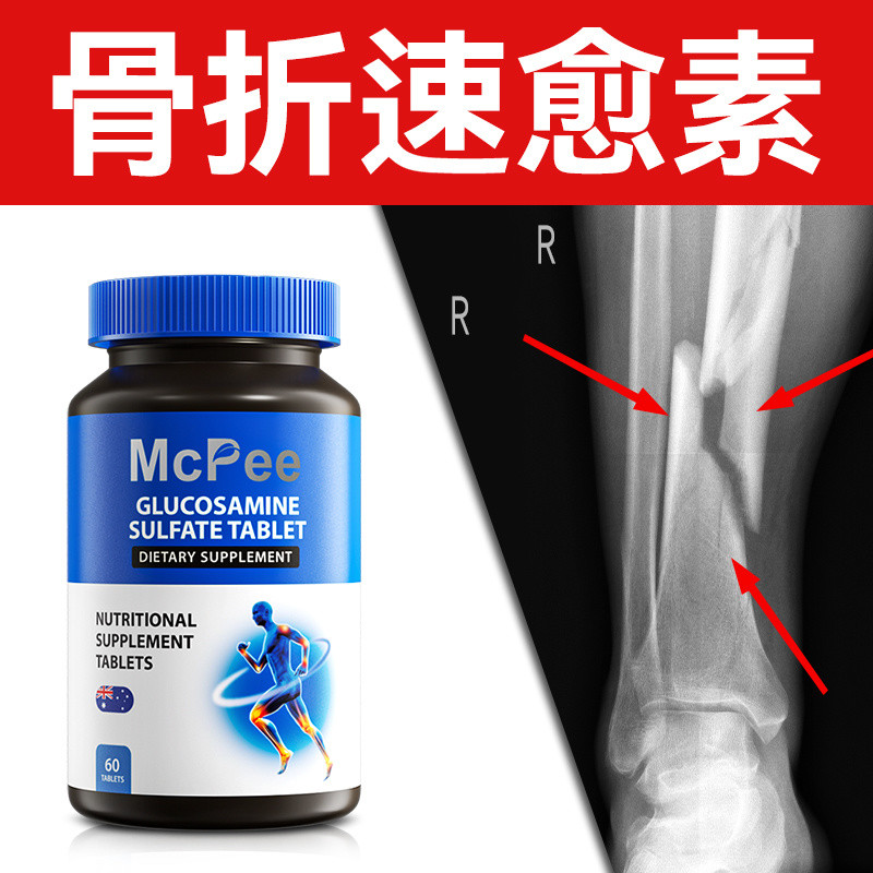 Mcpee Imported Fracture Fracture Recovery Nutritional Supplement Bone ...