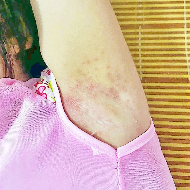 Armpit eczema, creaking, itchy red rash, small pimples in the AR armpit ...