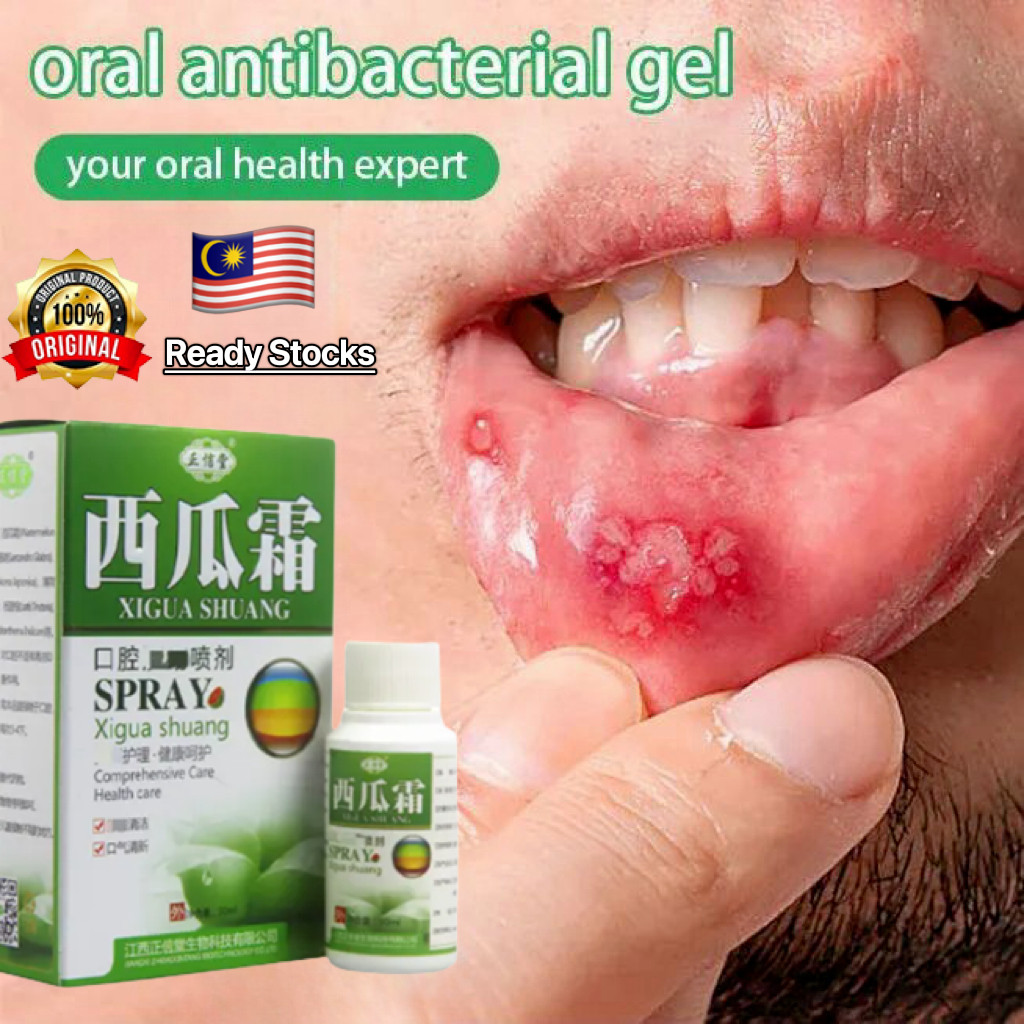 【Buy 2 Get 1 Free】Oral Ulcer Spray Mouth Ulcers Spray Ubat Semburan ...