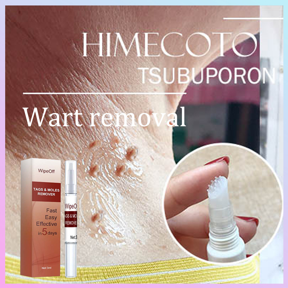 Skin tag remover Tahi lalat warts remover Buang tahi lalat dan kutil ...