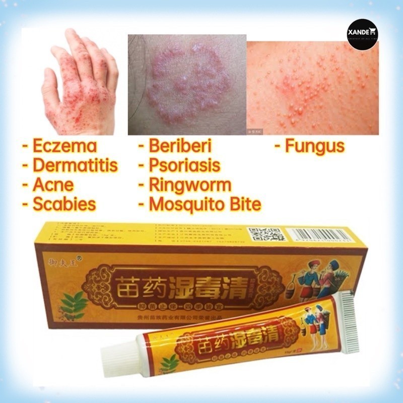 Eczema Psoriasis Beriberi Fungus 100% Chinese Herbal Cream Krim Gatal ...