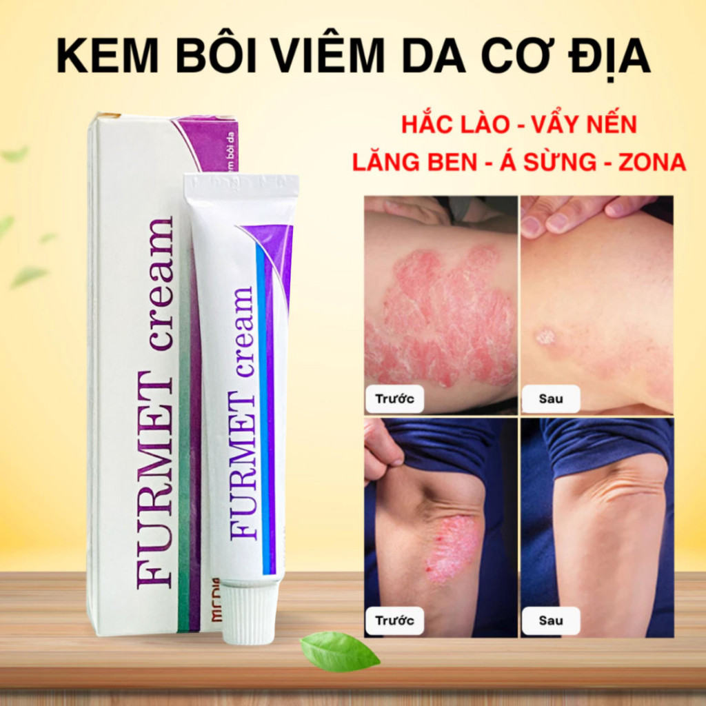 Topical Cream for Atopic Dermatitis to Eliminate Ringworm and Ringworm ...