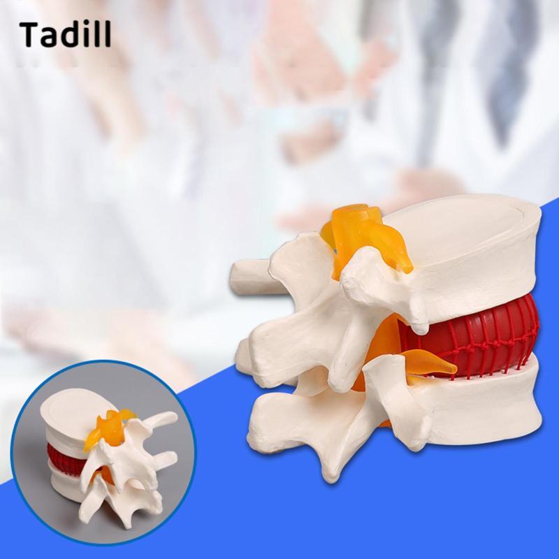 [dksqer] Human Disc Herniation Model Spine Model Anatomy Tool, Spine ...