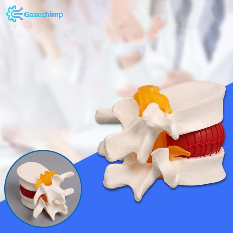 [Gazechimp] Human Disc Herniation Model Spine Model Anatomy Tool, Spine ...
