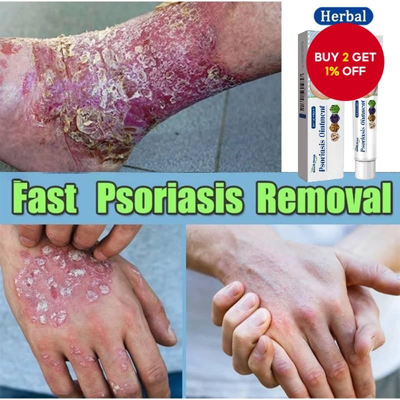 South Moon Psoriasis Cream Herbal Eczema Cream Effective Safe Relief ...