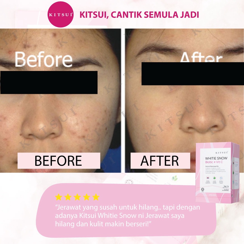 KITSUI Whitie Snow (Probiotic + Pencerahan Kulit) 17's x 15g | Shopee ...