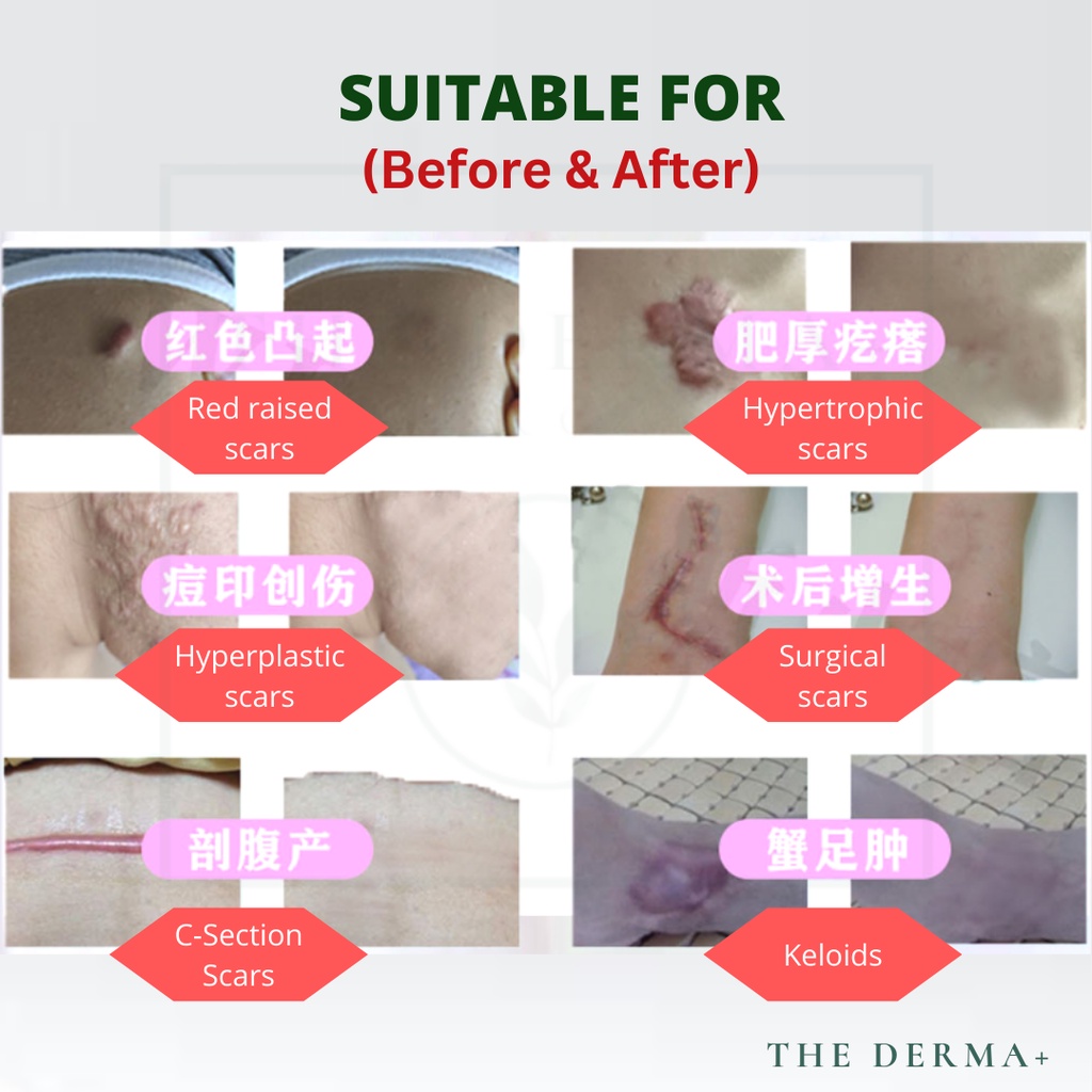 [Japan] Scar Removal / Keloid Treatment - Drenison Plaster Tape ...