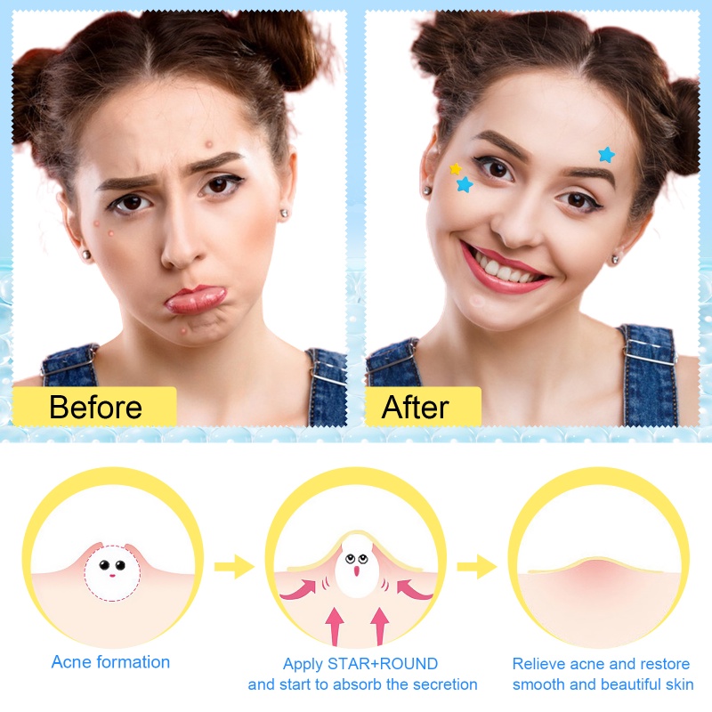1 Pc Colorful Love Star Acne Patch Face Spot Stickers Waterproof Acne ...