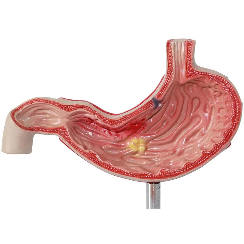 Human Stomach Model Gastric Ulcer Anatomy Model Medical Science ...