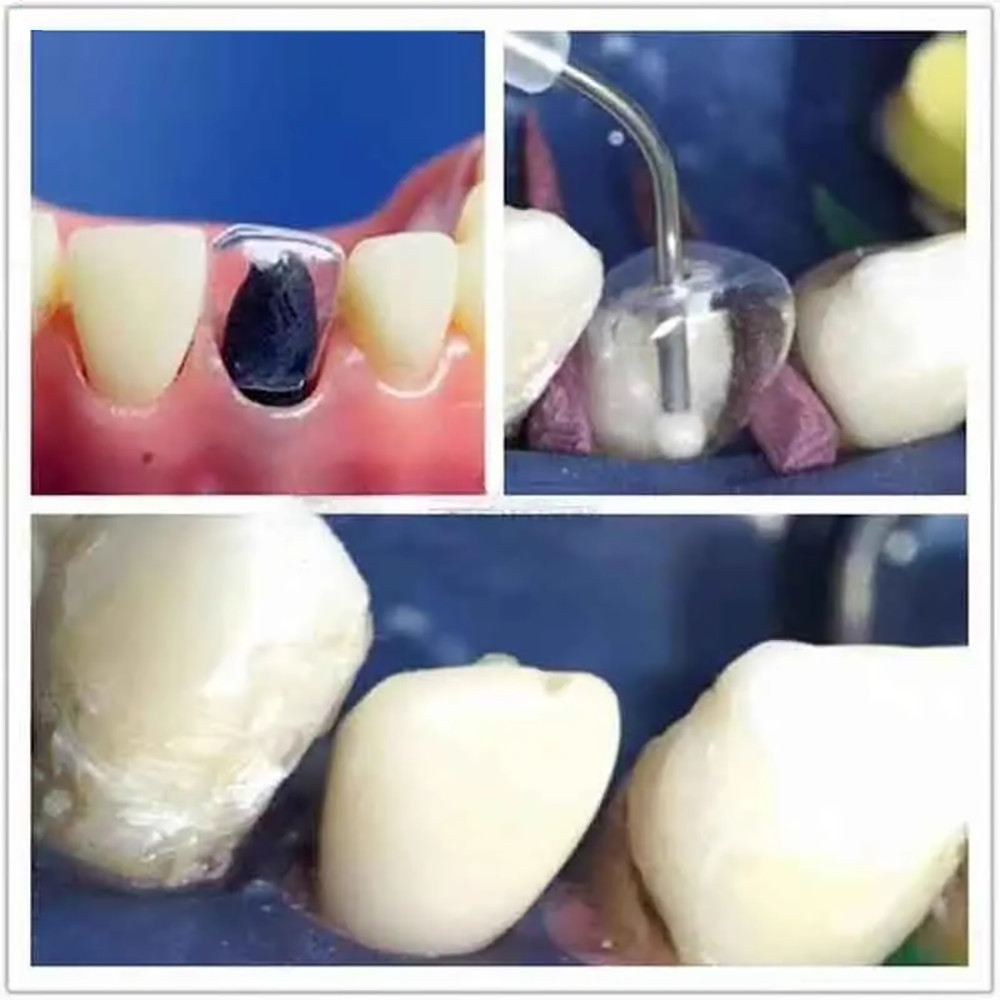 Dental Transparent Crowns Adult Kids Dentist Kit 1.910/1.912 Temporary ...