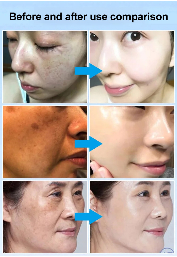 [Buy 1 Free 1] 21Days Old Spots/ Yellow Spots Disappear Spot Fading Vitamin E Urea Cream ...