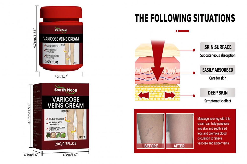Varicose Vein Cream Leg Circulation Cream 20g Varicose Veins Cream ...