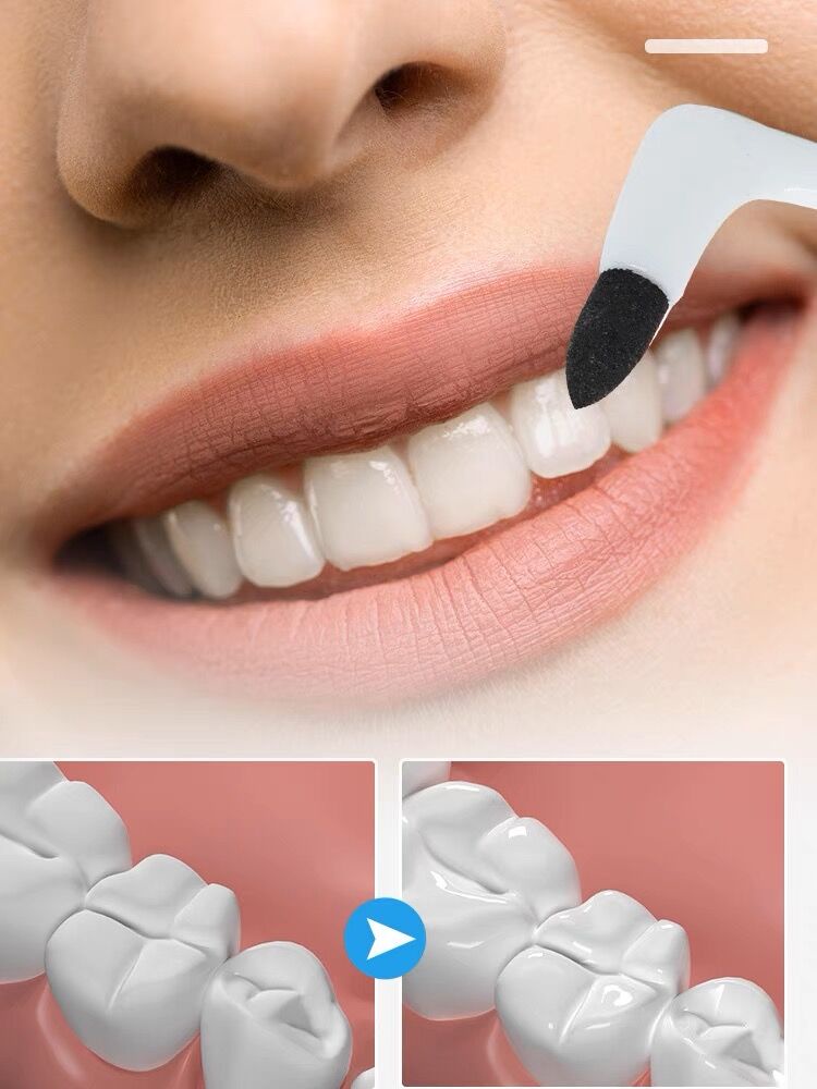 Dental Oral Tooth Stain Eraser Tartar Plague Remover Teeth Whitening ...