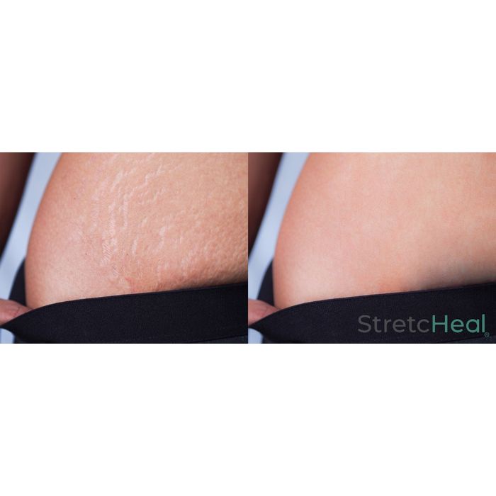 Genuine StretcHeal Stretch Mark Cream 180ml Made in USA | Shopee Malaysia