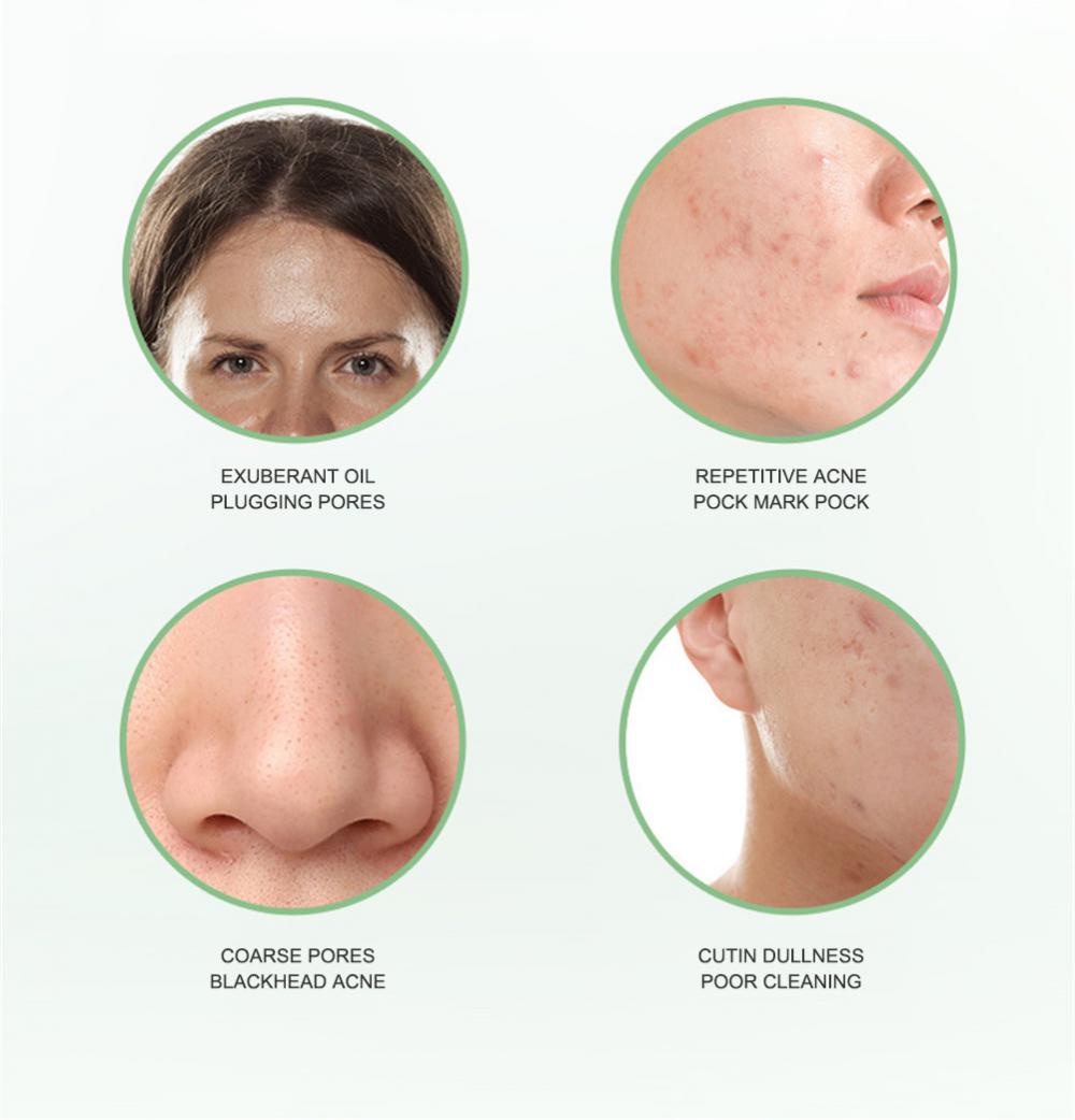 Salicylic acid cream helps reduce blackhead acne, alkaline oil, Se ...