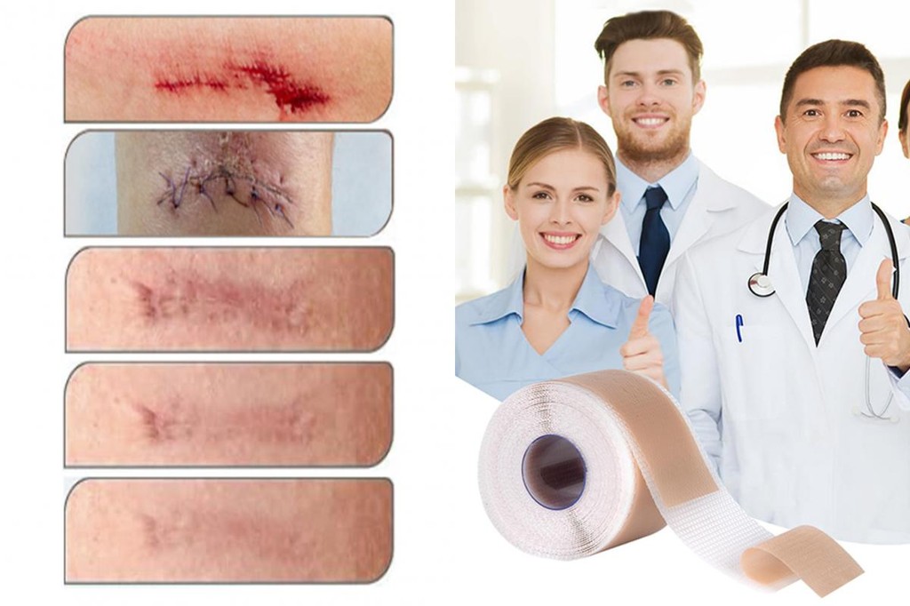 IBN- Scar Gel Patch Moisturizing Scar Treatment Professional Silicone ...