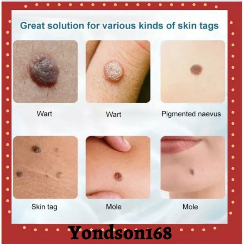 Y82 Concentrated potent skin tag removal cream Mole Cream No Mark ...