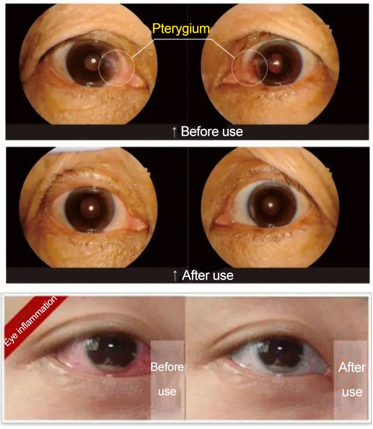 Ubat titisan mata rabun Jepun Ophthalmology mengesyorkan rawatan ...
